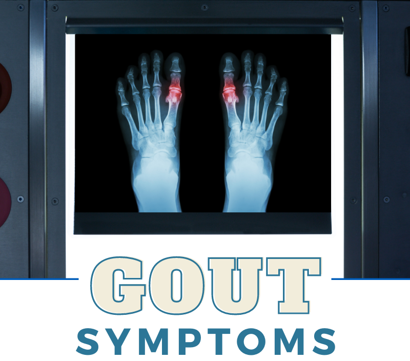 Life With Gout: Here’s Everything You Need to Know