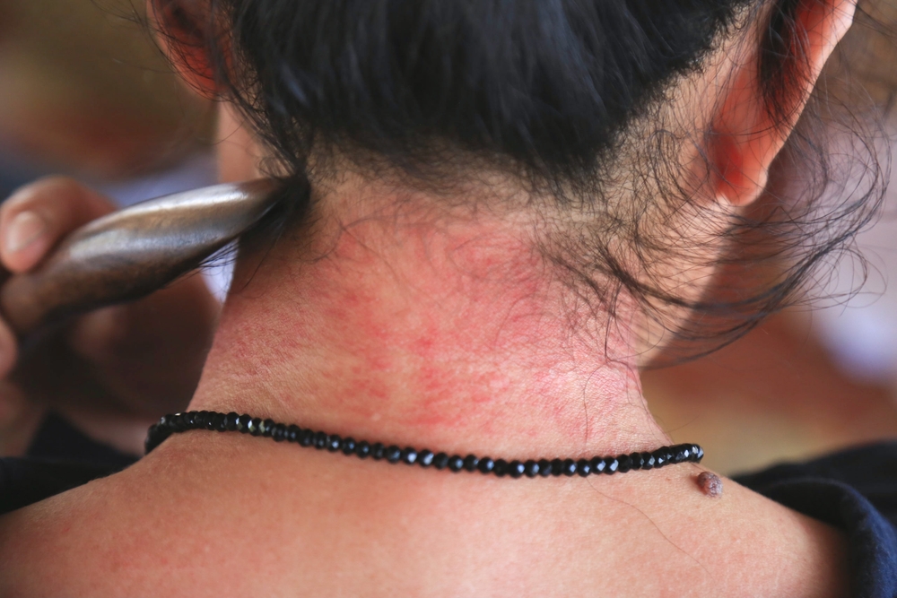 Lupus Rash On Back Lupus And Your Skin: Signs And Symptoms