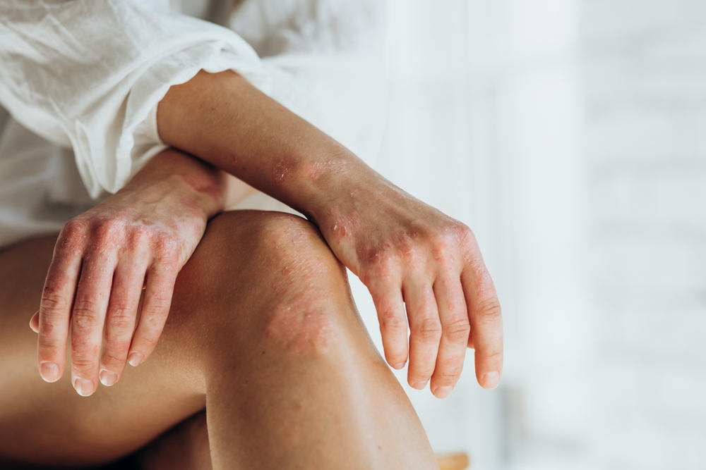 Early Signs Of Psoriatic Arthritis Arbda
